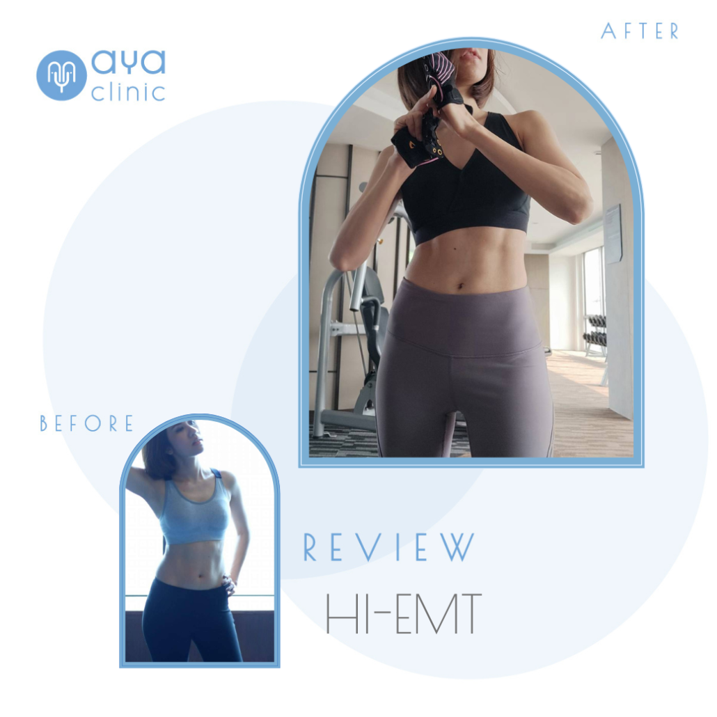 สร้างหุ่นเฟริ์มด้วย HI-EMT กระชับสัดส่วนด้วยคลื่นพลังงาน